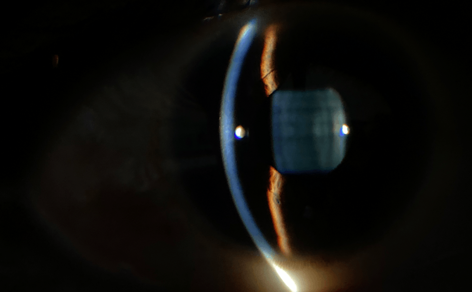 Remidio PSL D20 | Hand Held Portable Slit Lamp